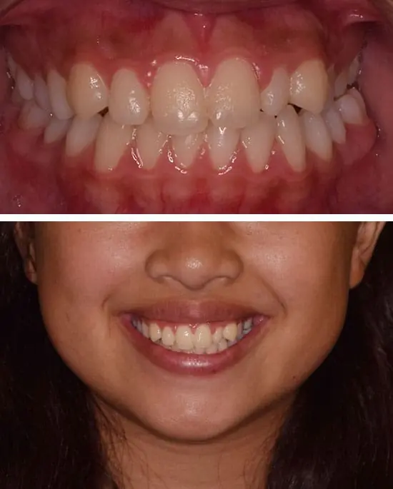 Common Bite Problems | Natalie Yang Orthodontics - Vacaville Orthodontist